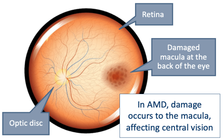 Age-related Macular Degeneration (AMD) Treatment Candidate