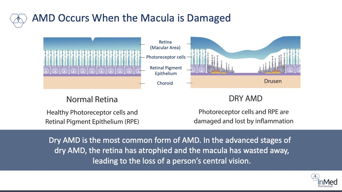 What is Age-related Macular Degeneration? Does AMD Cause Blindness ...